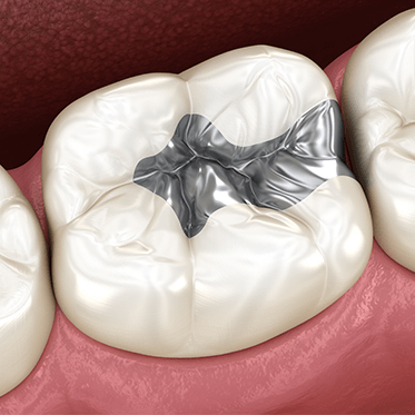 Fillings - Maida Vale Dental Practice | Dentist in Maida Vale, London